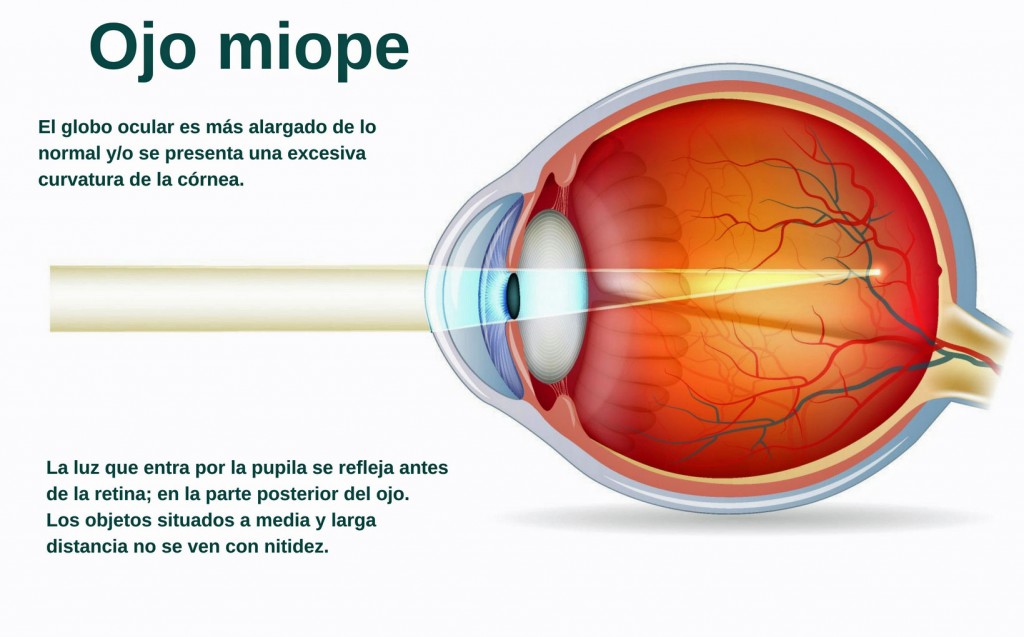 Ojo Miope